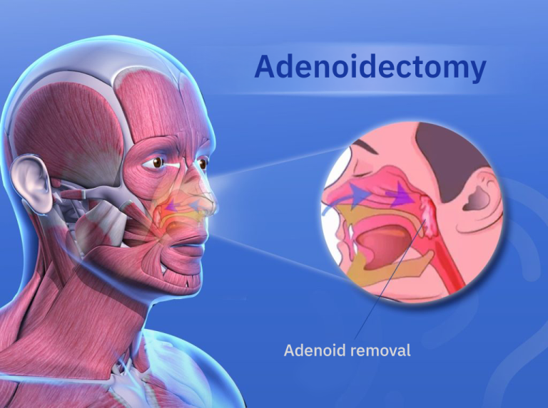 Tonsillectomy and Adenoidectomy - Dr.. Saleh Al-Omari