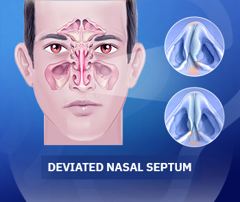 Nasal Septum Deviation: Causes, Symptoms & Treatment