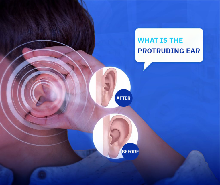 Bat Ear: Causes, Treatment Options, and Surgical Considerations