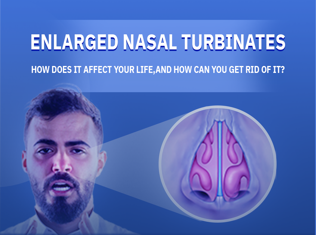 Nasal Turbinates Hypertrophy: How It Affects You and How to Treat It