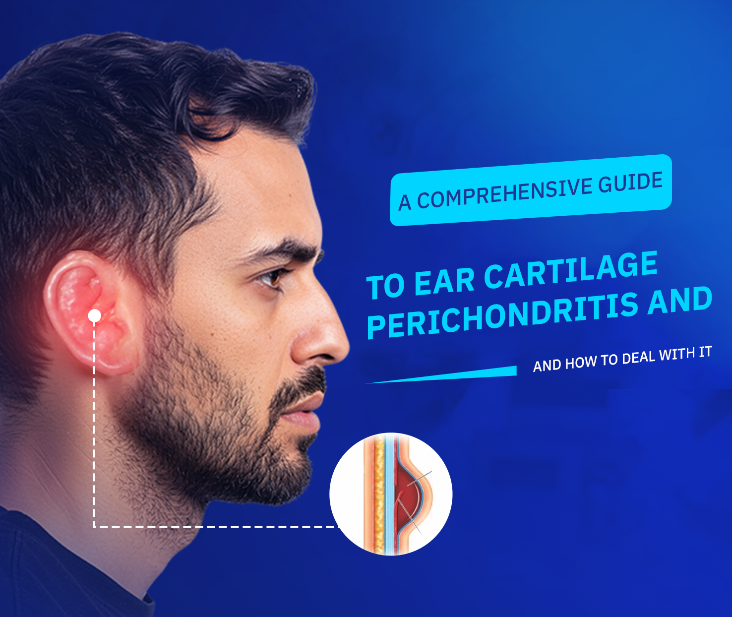 Perichondritis: Causes, Symptoms, and Effective Treatments