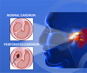 Tympanoplasty (eardrum repair surgery)